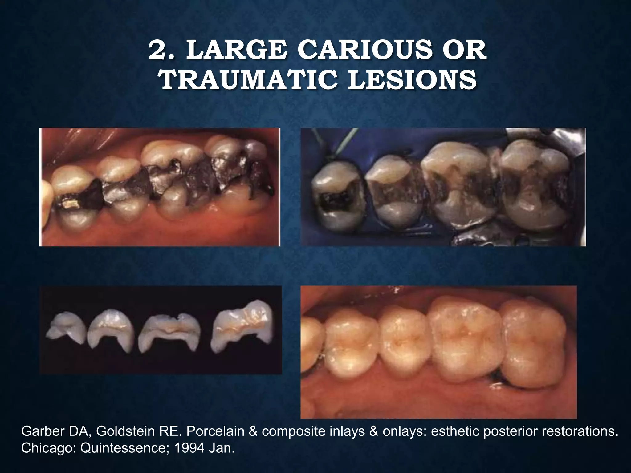 Ceramic inlays and onlays | PPTX