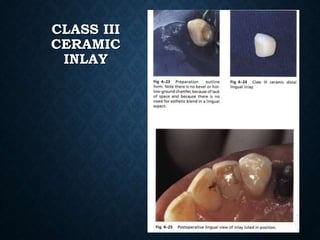 Ceramic inlays and onlays | PPTX