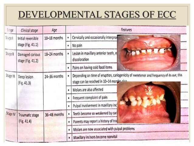 EARLY CHILDHOOD CARIES | PPTX | Dental Health | Diseases and Conditions