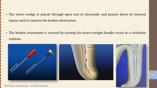 Endodontic Retreatment