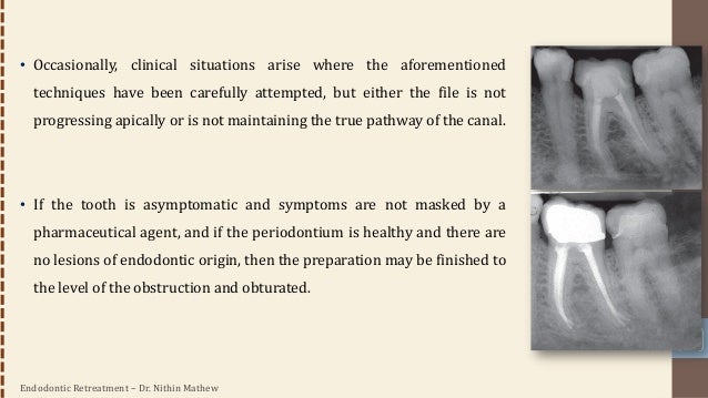 Endodontic Retreatment