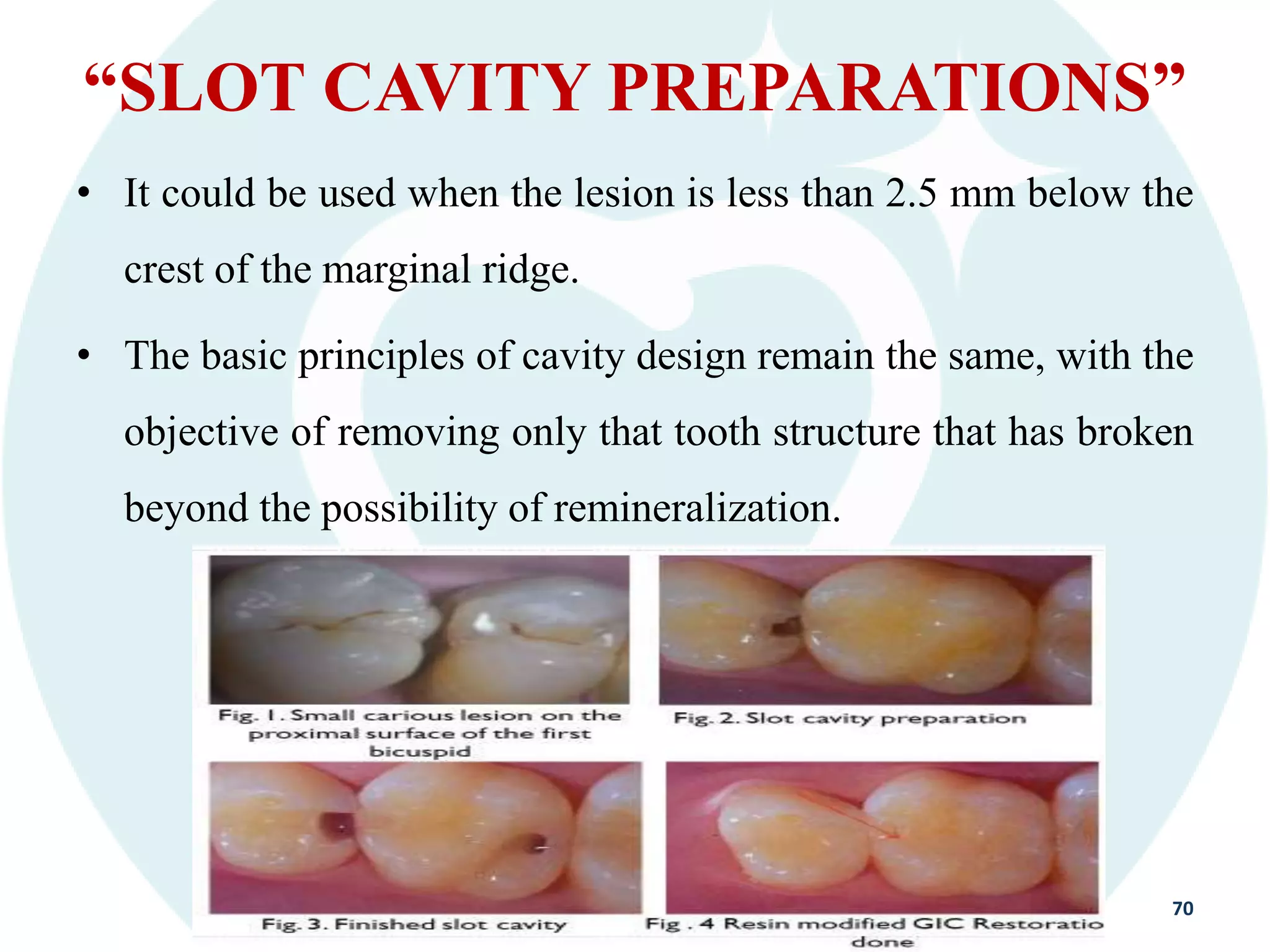 Minimal Invasive Dentistry | PPTX