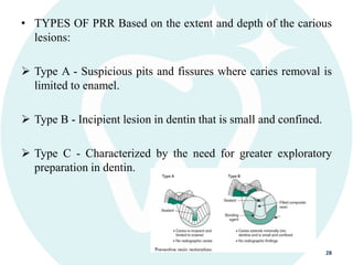 Minimal Invasive Dentistry | PPTX