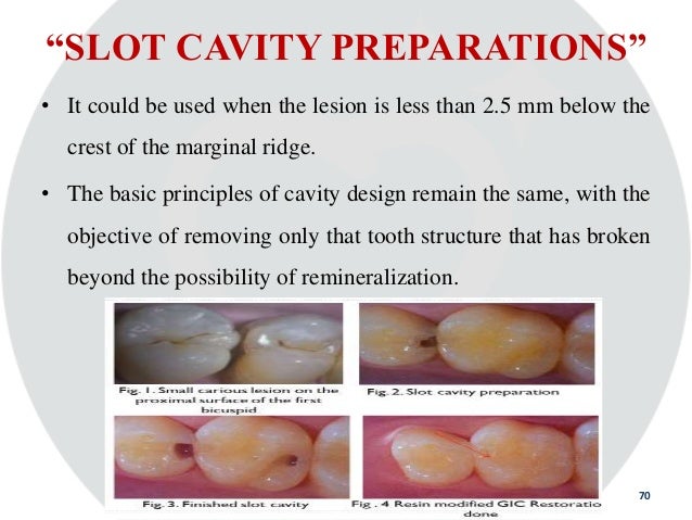 Minimal Invasive Dentistry