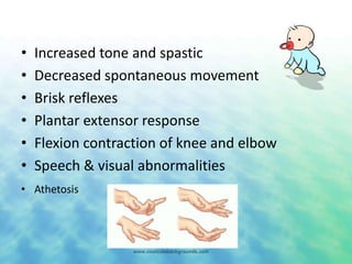 Cerebral palsy | PPTX