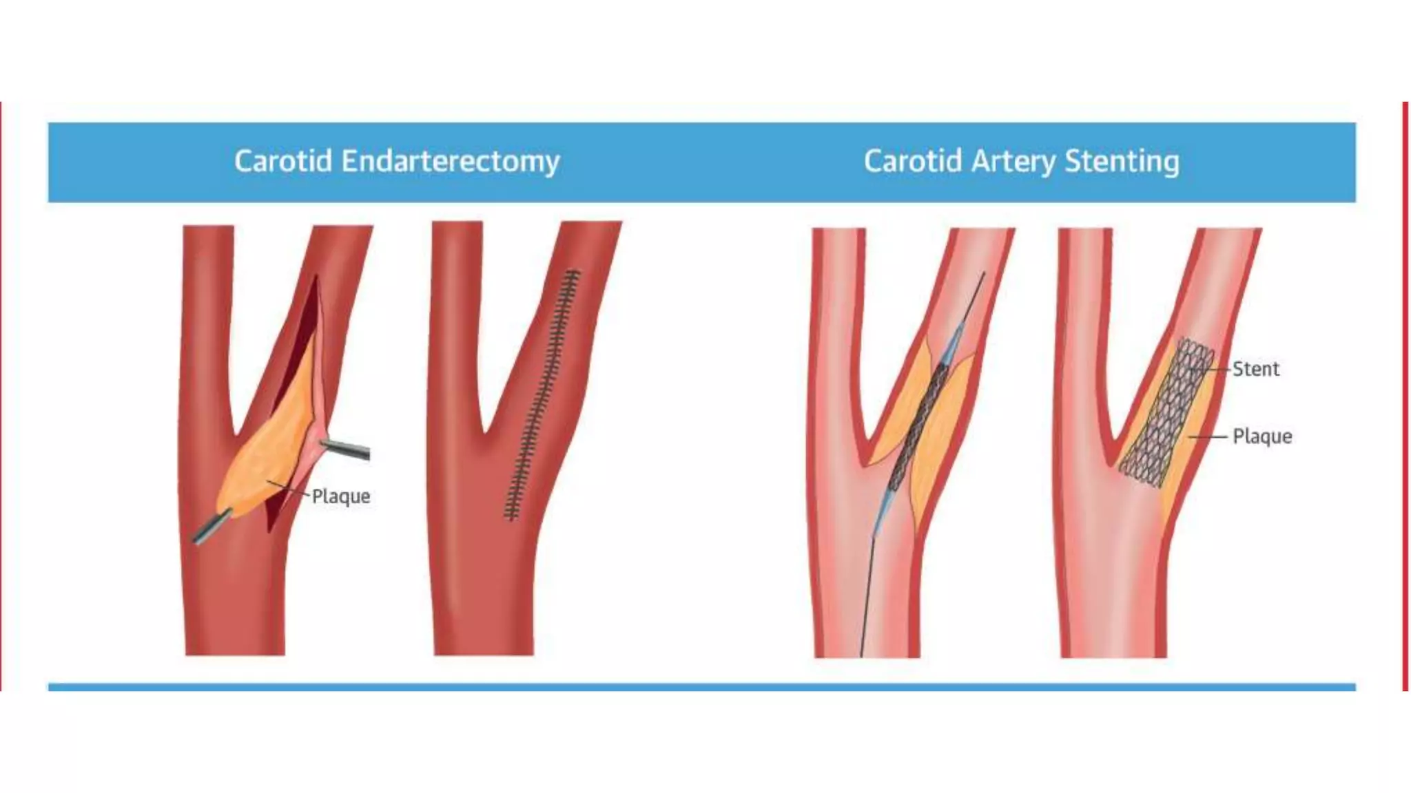 Carotid endarterectomy versus carotid stenting | PPTX | Heart and ...