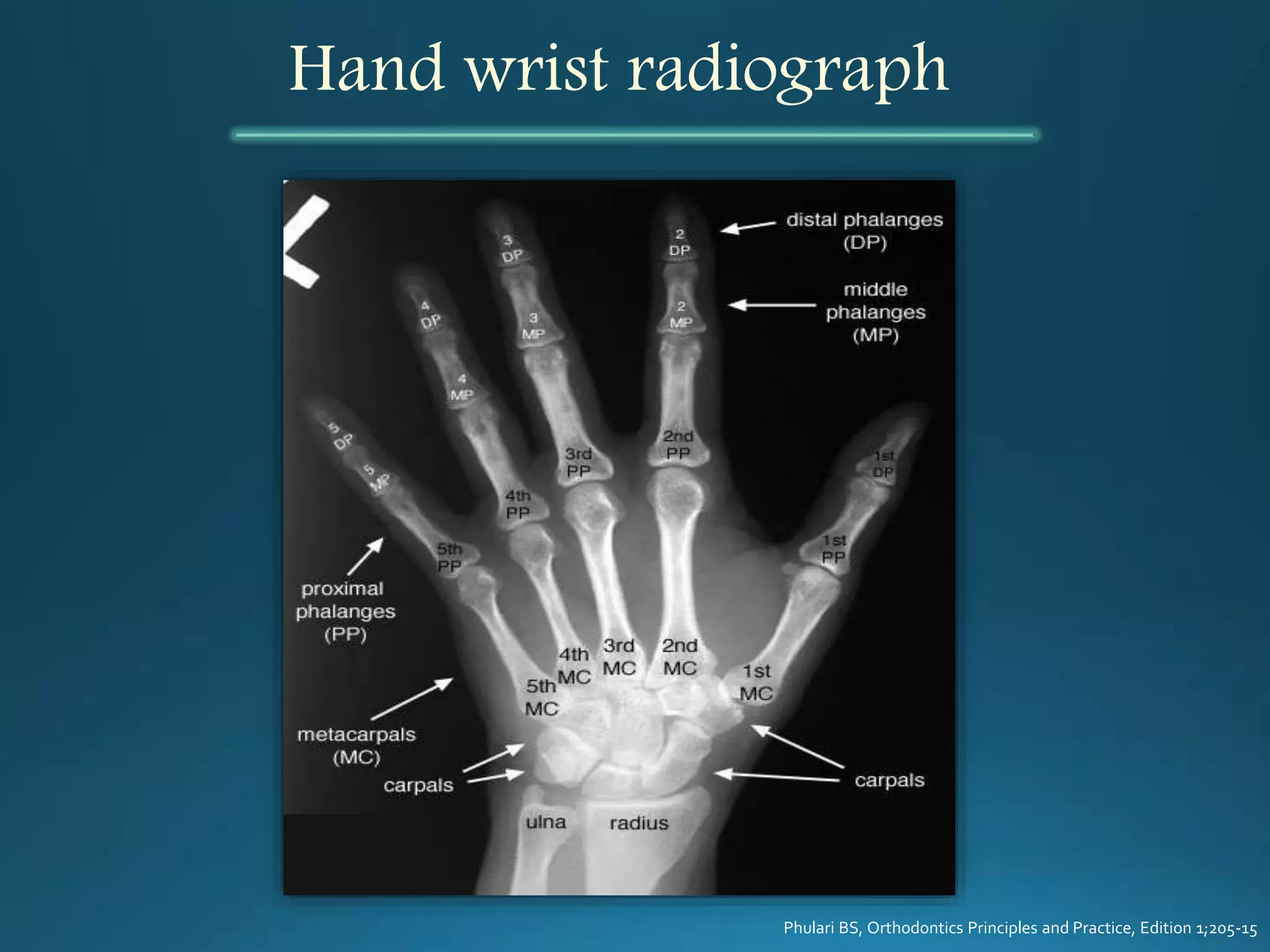 Hand Wrist Radiography | PPTX
