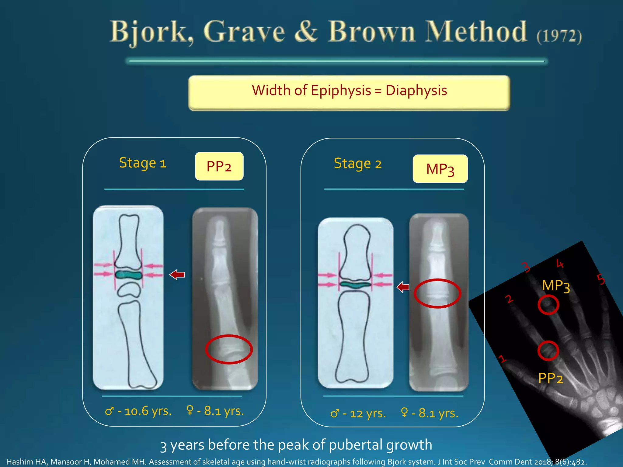 Hand Wrist Radiography | PPTX