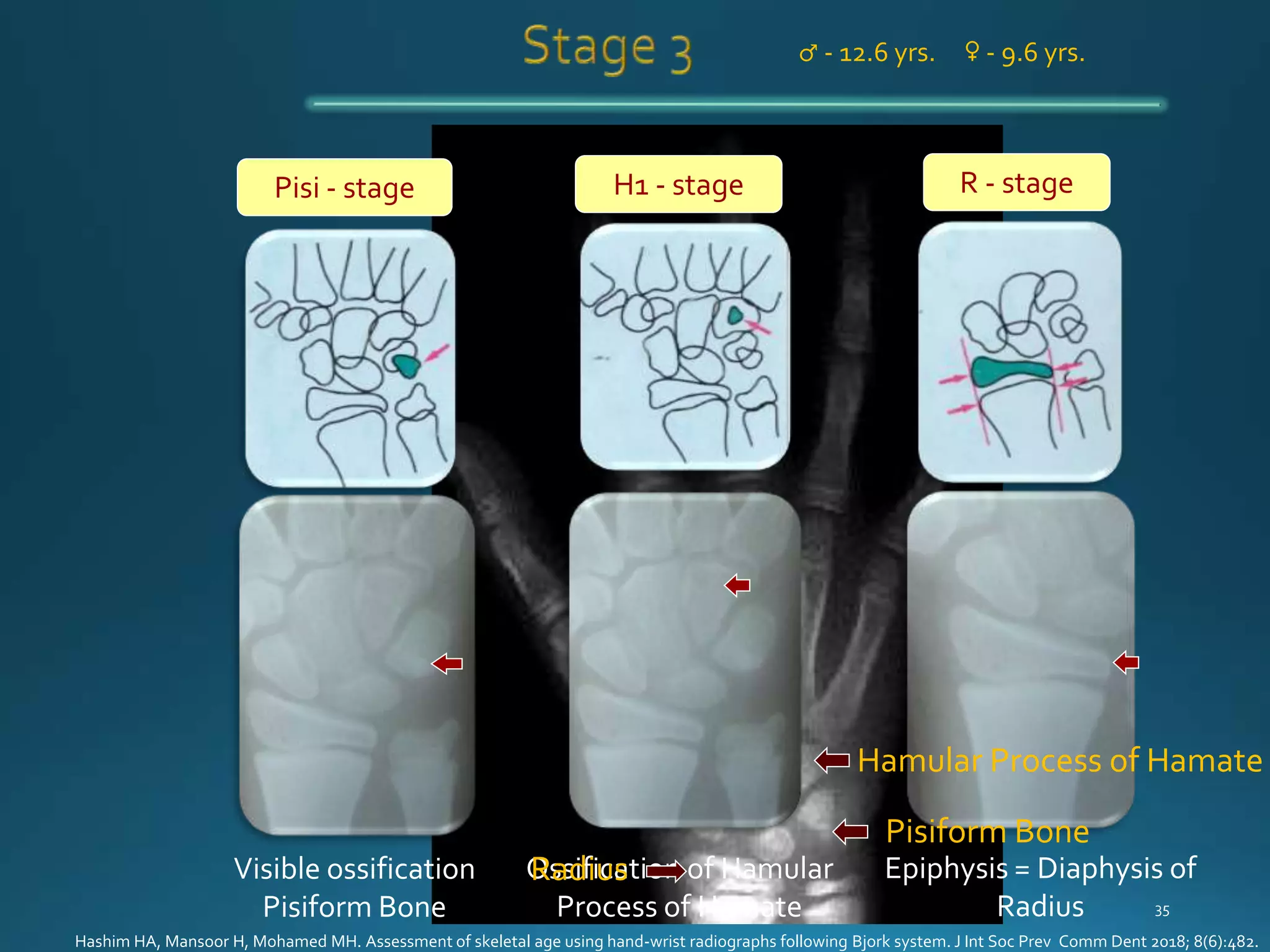 Hand Wrist Radiography | PPTX