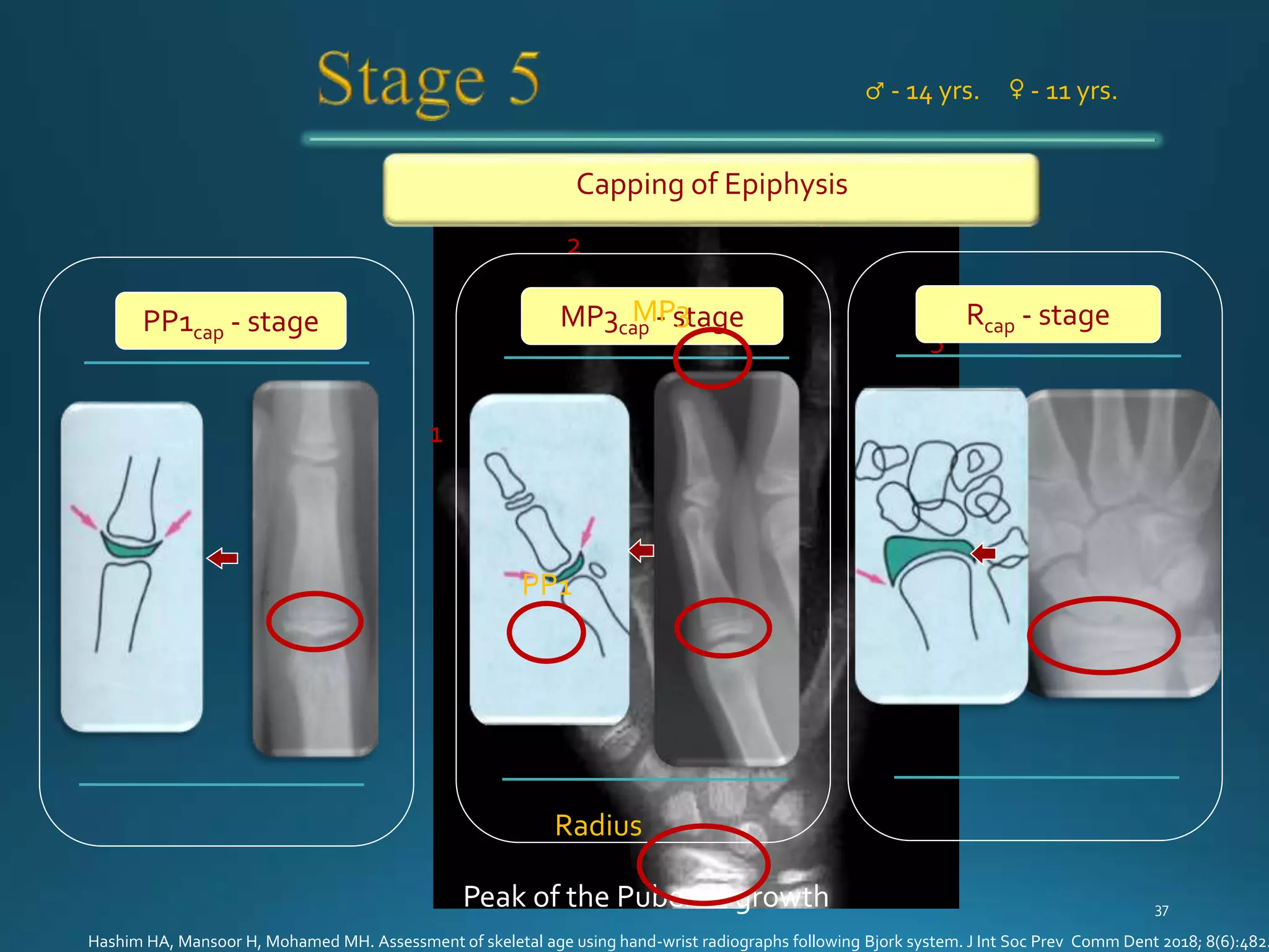 Hand Wrist Radiography | PPTX