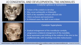 Temporomandibular Joint (Anatomy) | PPTX
