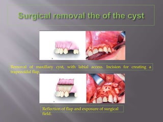 SURGICAL MANAGEMENT OF ODONTOGENIC CYSTS | PPTX