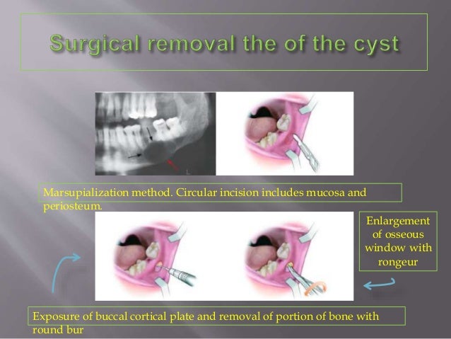 SURGICAL MANAGEMENT OF ODONTOGENIC CYSTS