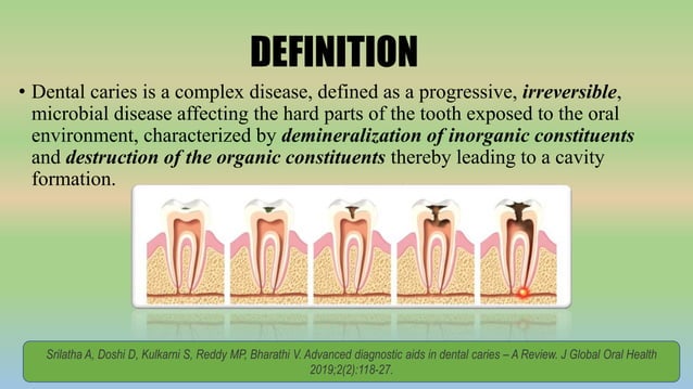 Recent advances in dental caries diagnosis | PPTX