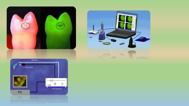 Recent advances in dental caries diagnosis | PPTX