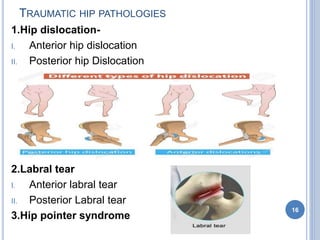 Differential diagnosis of hip | PPTX
