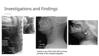 Seminar 2 - Acute stridor, causes, features and management | PPTX