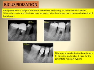 Endo - Perio lesions | PPTX