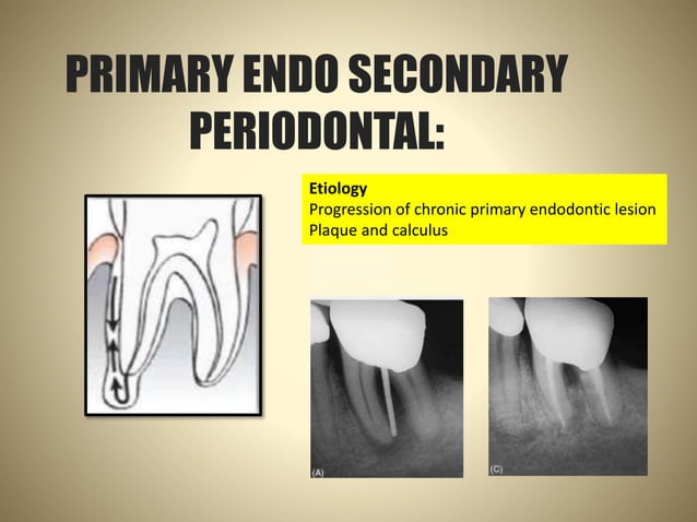 Endo - Perio lesions | PPT