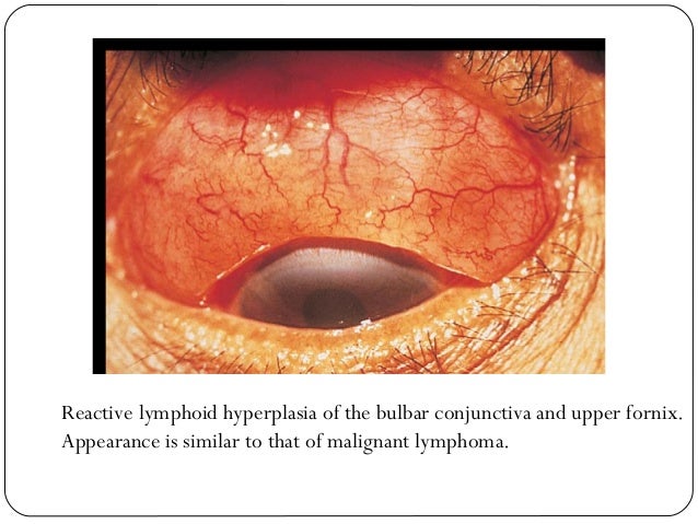 ocular lymphoma