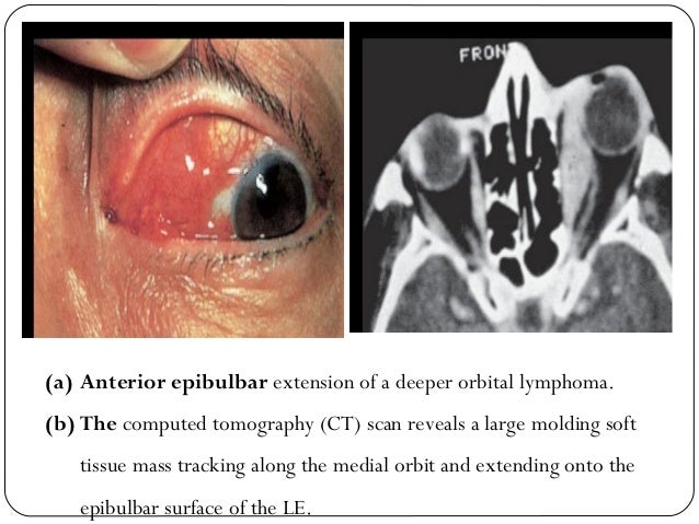 ocular lymphoma