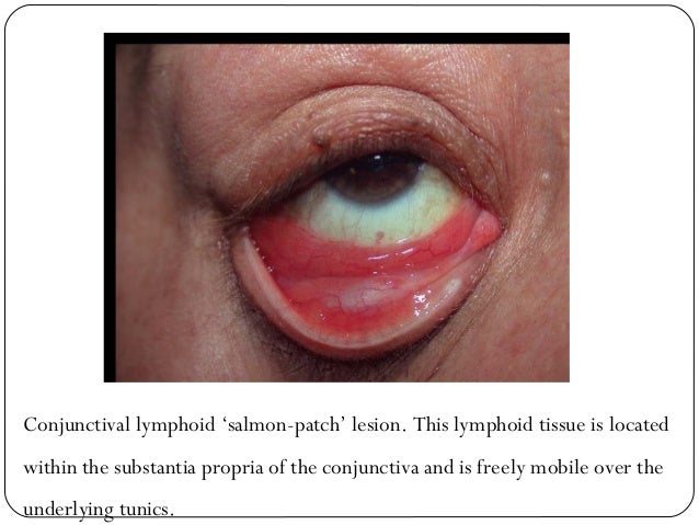 ocular lymphoma