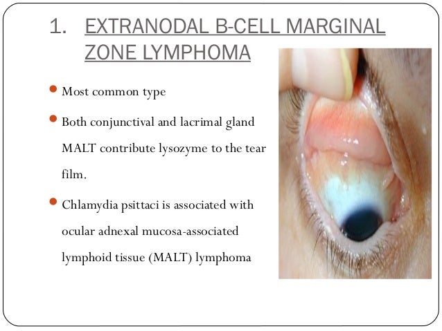 ocular lymphoma