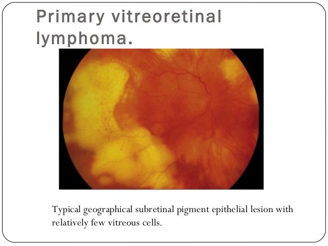 ocular lymphoma