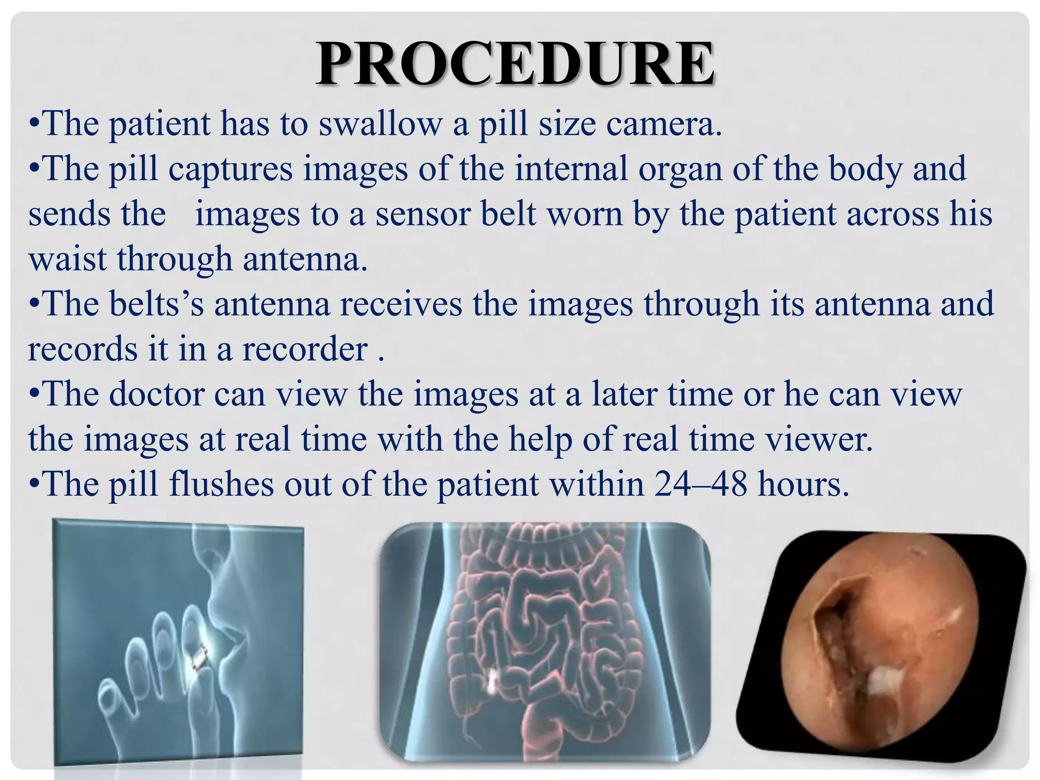 Pill Camera Technology | PPTX