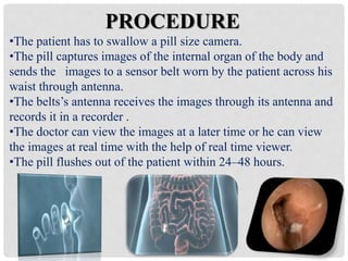 Pill Camera Technology | PPTX