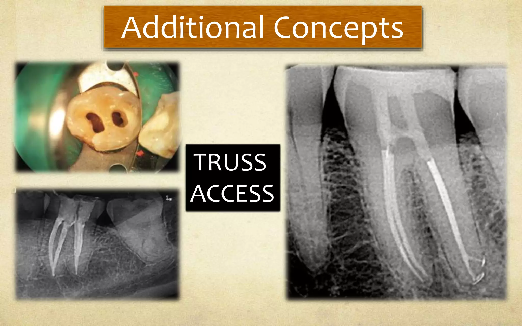 Current Concepts in Access Cavity Preparation | PPTX