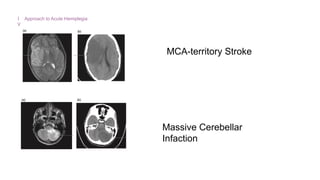 anatomy of pyramidal tracts and approach to acute hemiplegia.pptx