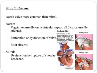 Seminar of Endocarditis by Sudeep,(Pharm.D.) | PPTX