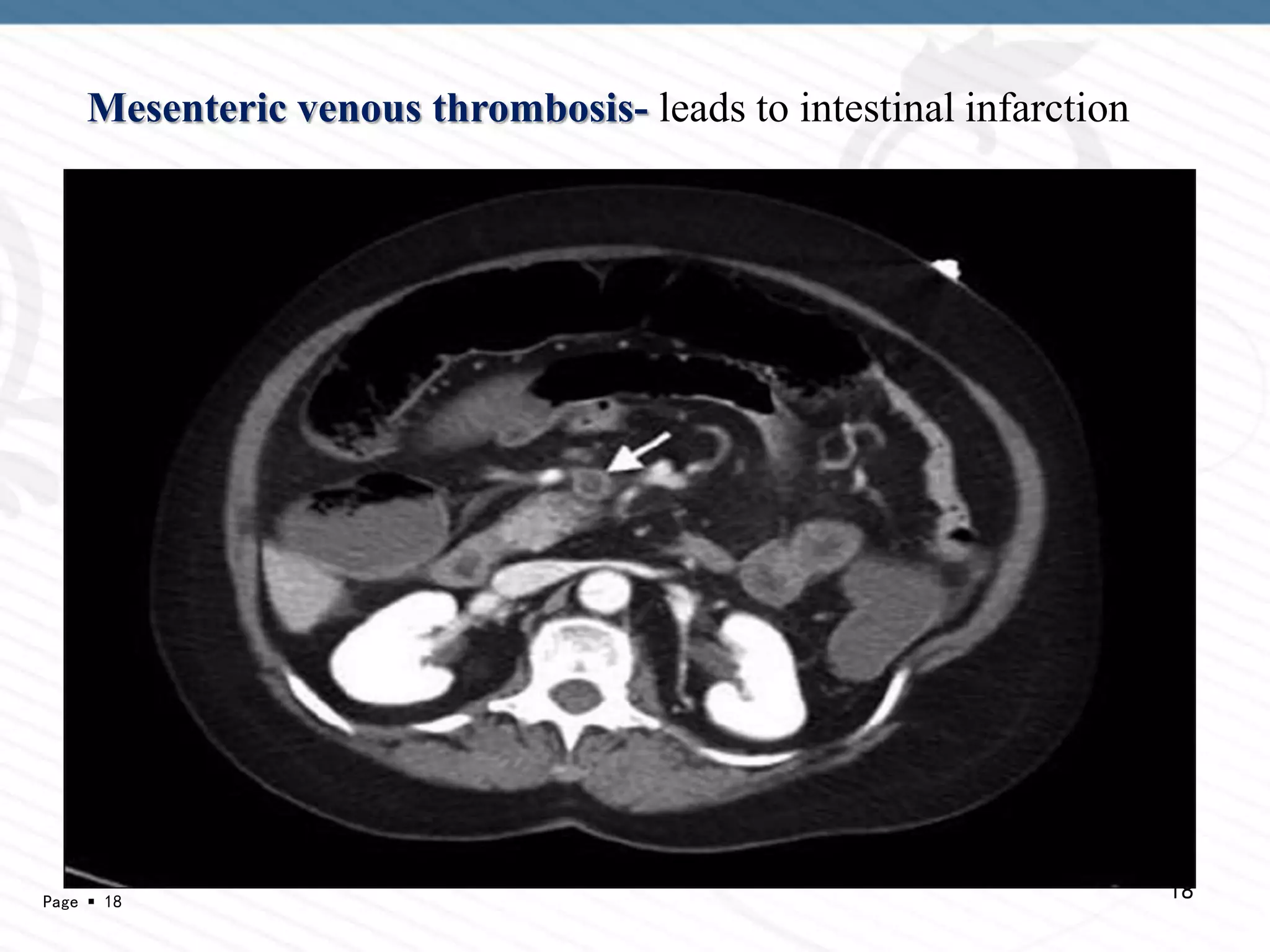 Ischemia and Infarction | PPTX
