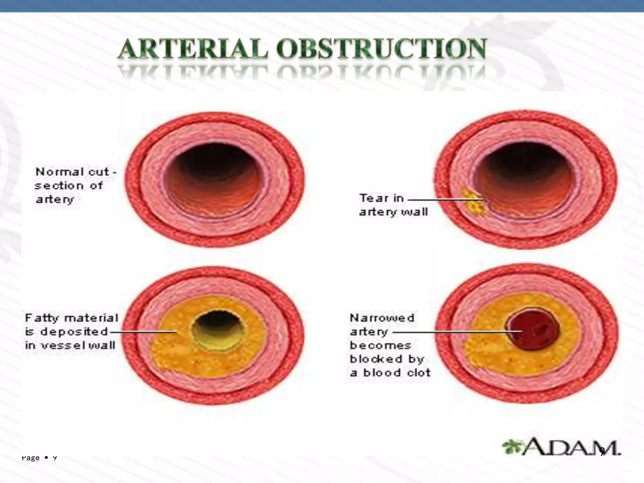 Ischemia and Infarction | PPTX