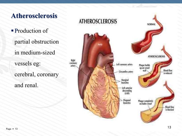 Ischemia and Infarction | PPTX | Blood Disorders | Diseases and Conditions
