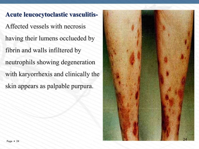 Ischemia and Infarction | PPTX | Blood Disorders | Diseases and Conditions