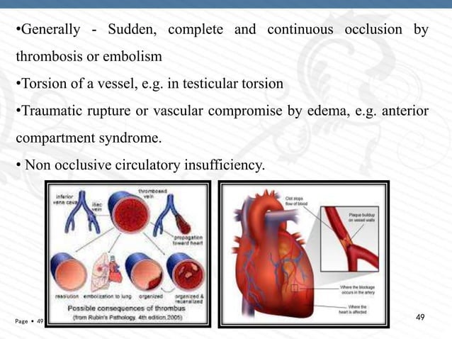 Ischemia and Infarction | PPTX | Blood Disorders | Diseases and Conditions