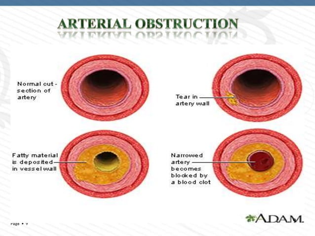Ischemia and Infarction | PPTX | Blood Disorders | Diseases and Conditions