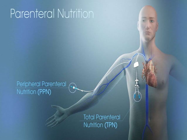 TOTAL PARENTERAL NUTRITION | PPTX | Digestive Disorders | Diseases and ...