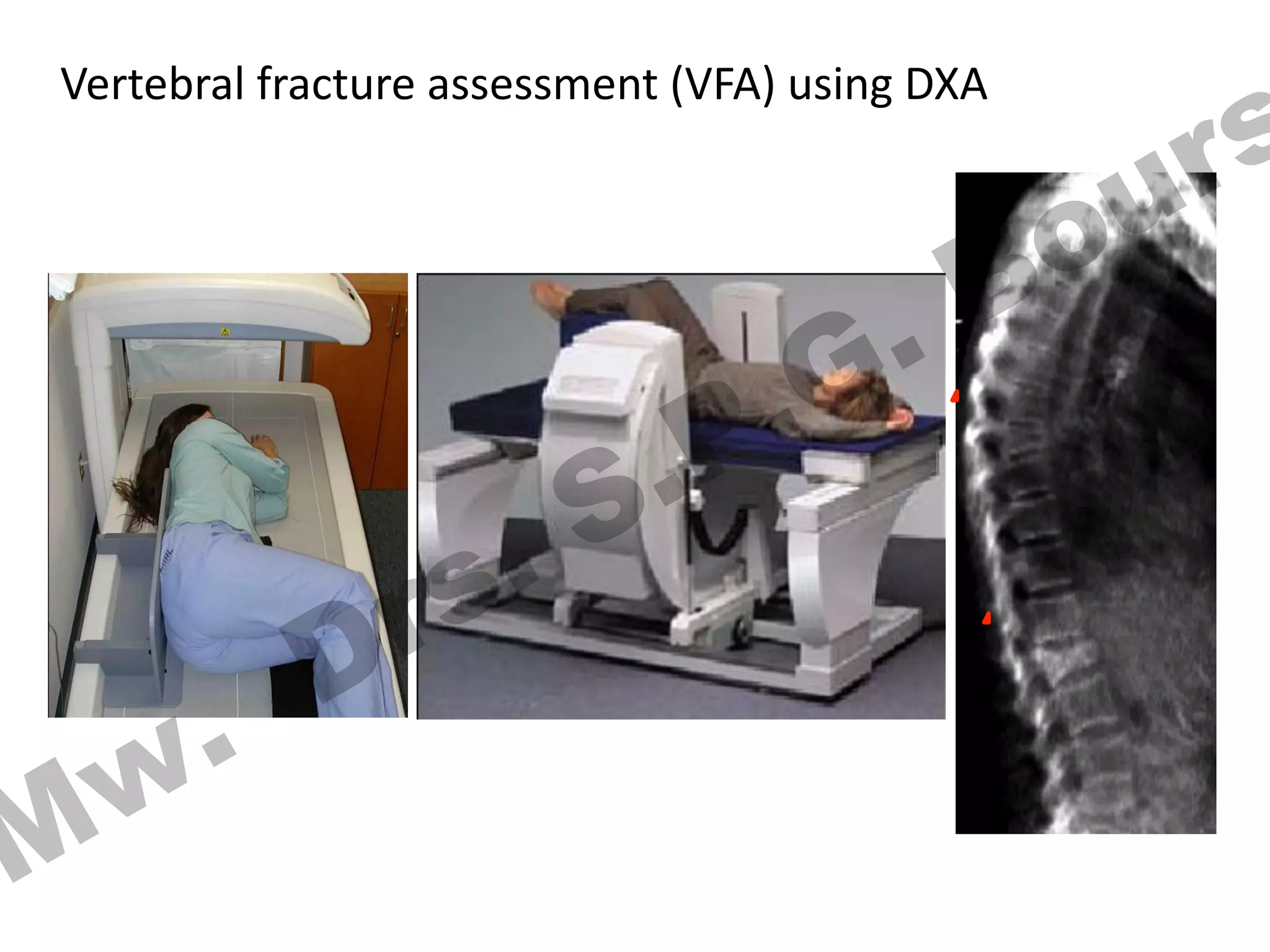 Seminar 30 11-2013 assessment of vertebral fractures | PDF