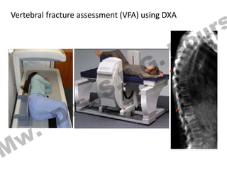 Seminar 30 11-2013 assessment of vertebral fractures | PDF
