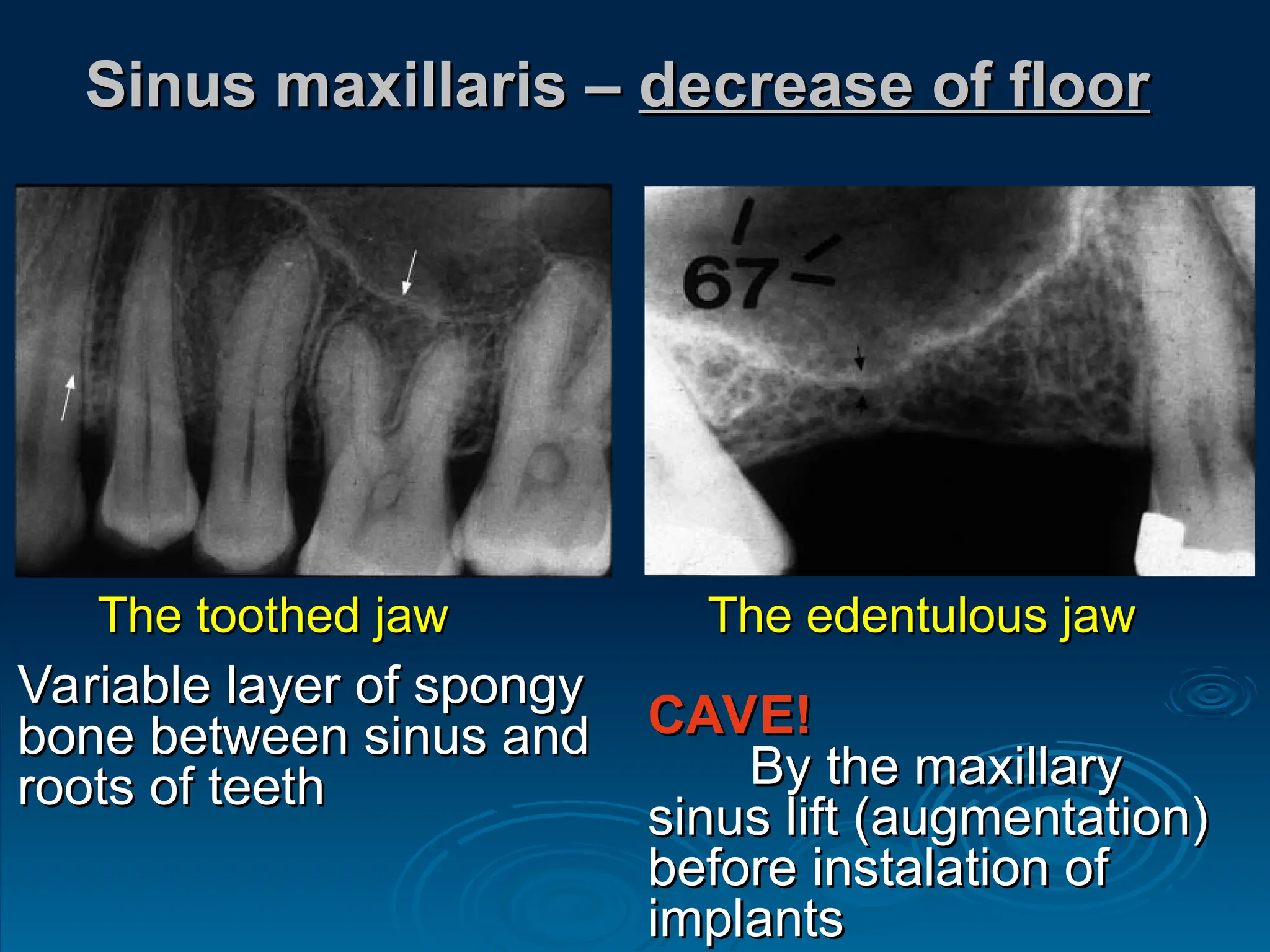 Seminar 3 Anatomy of Maxilla, growth blood supply | PPT