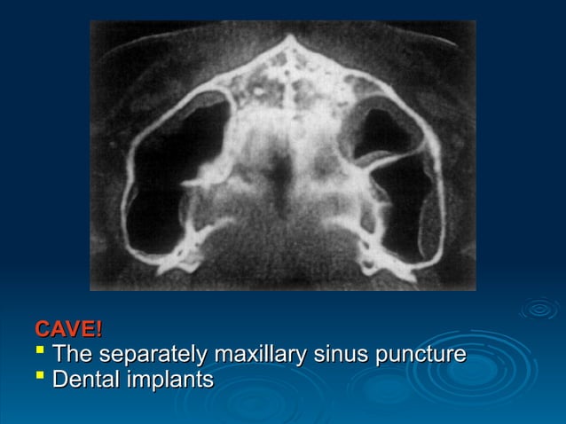 Seminar 3 Anatomy of Maxilla, growth blood supply | PPT | Bone and ...