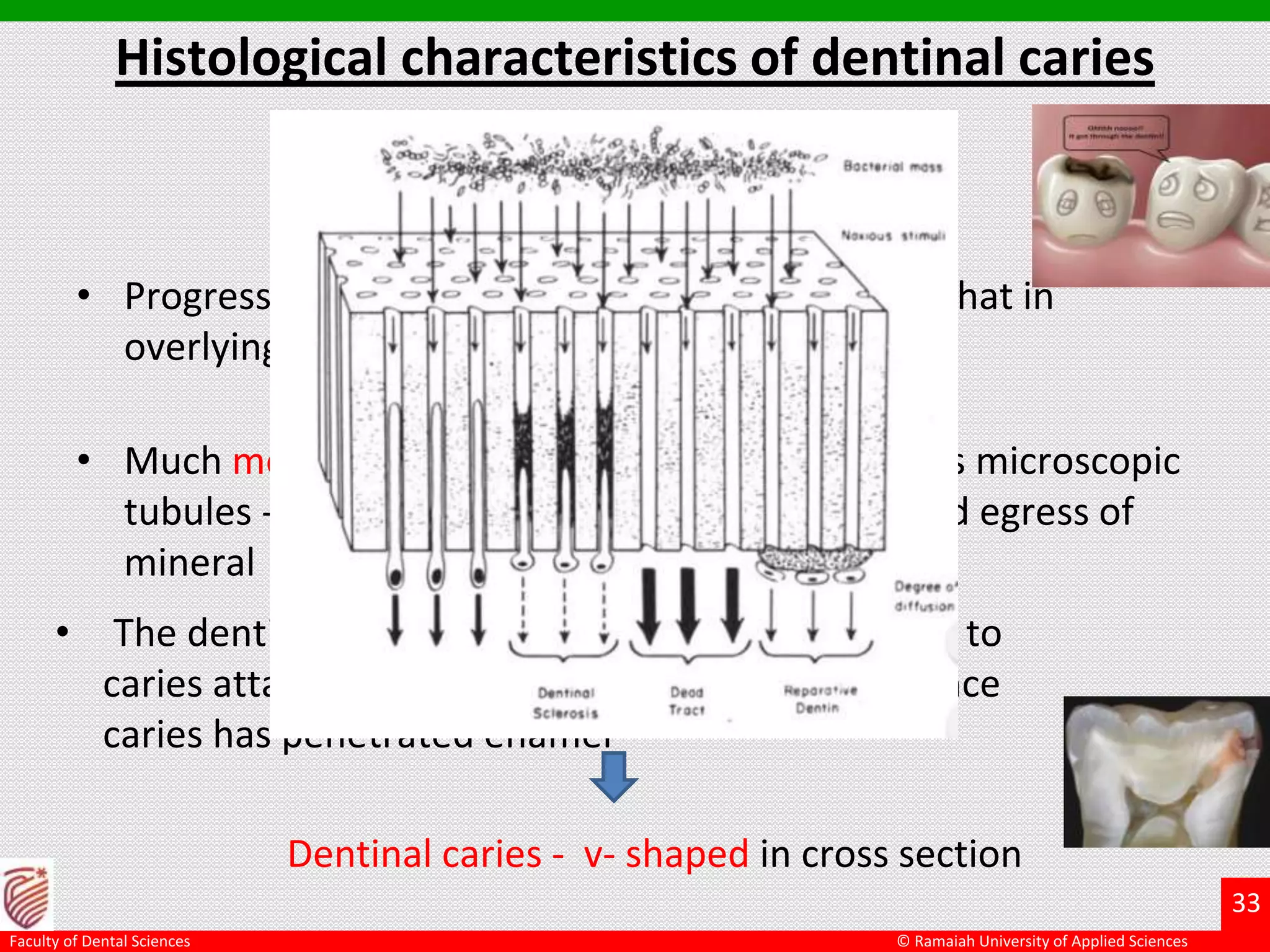 Pathophysiology of caries and pulpal reactions to caries | PPTX
