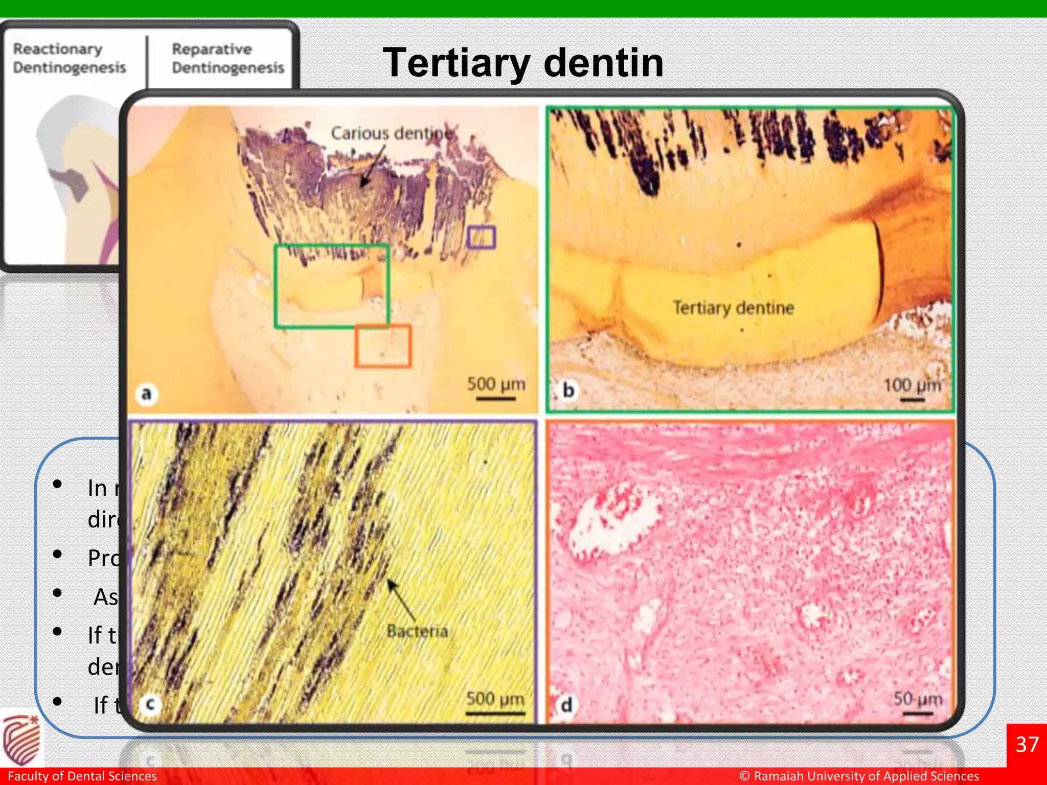 Pathophysiology of caries and pulpal reactions to caries | PPTX