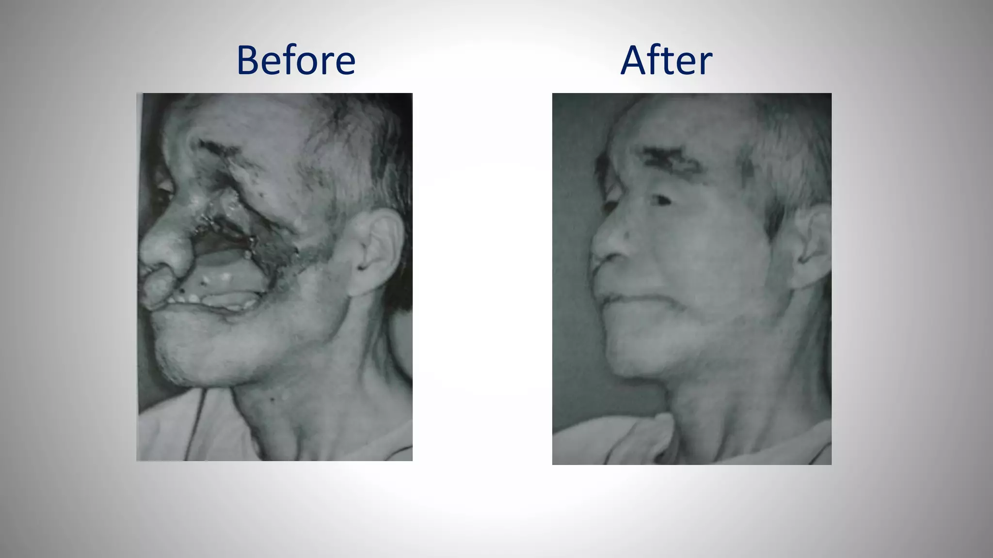 maxillofacial prosthesis materials | PPTX