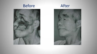maxillofacial prosthesis materials | PPTX