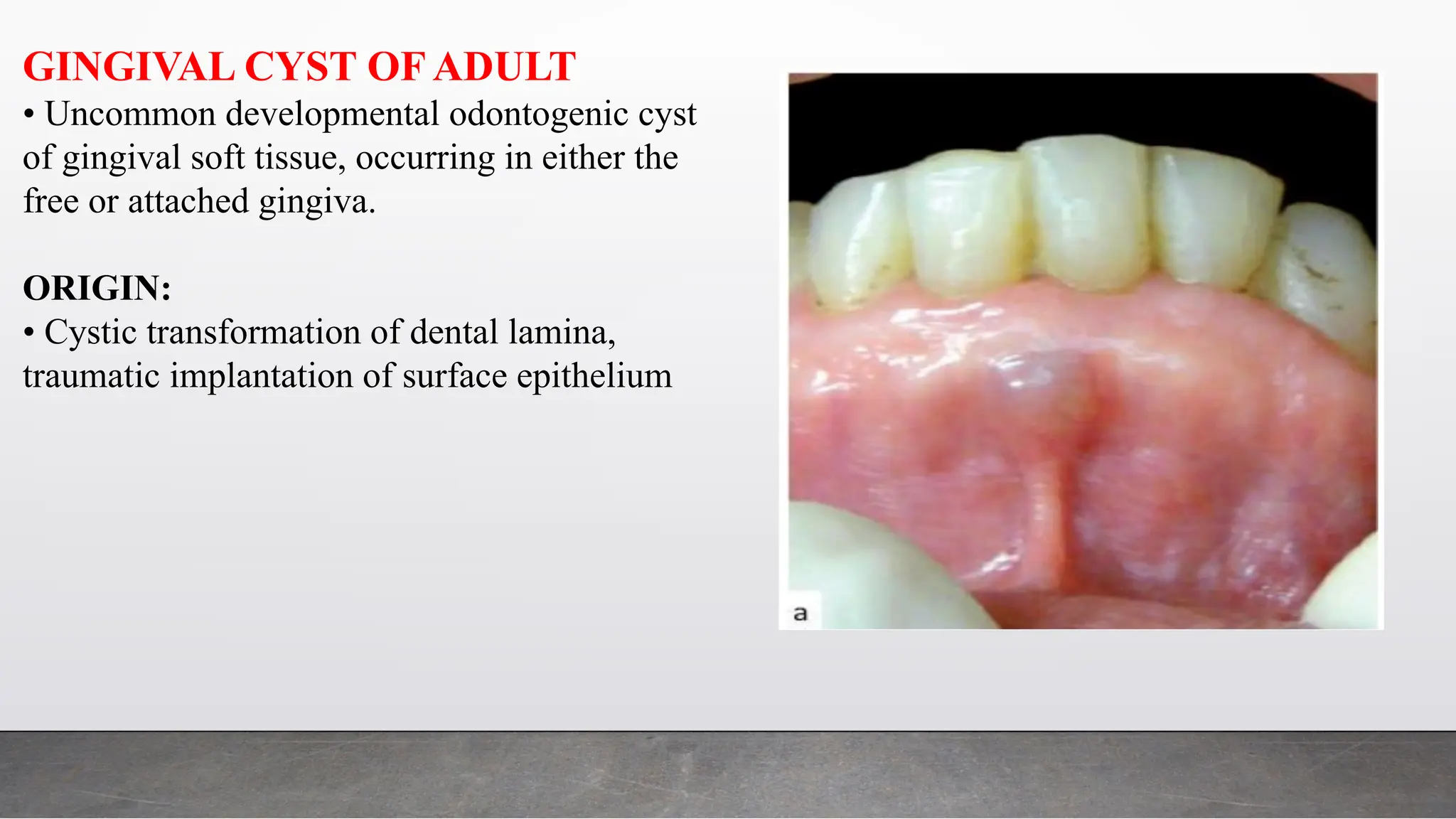 Seminar 3 Odontogenic cyst clinical feature , radiography | PPTX