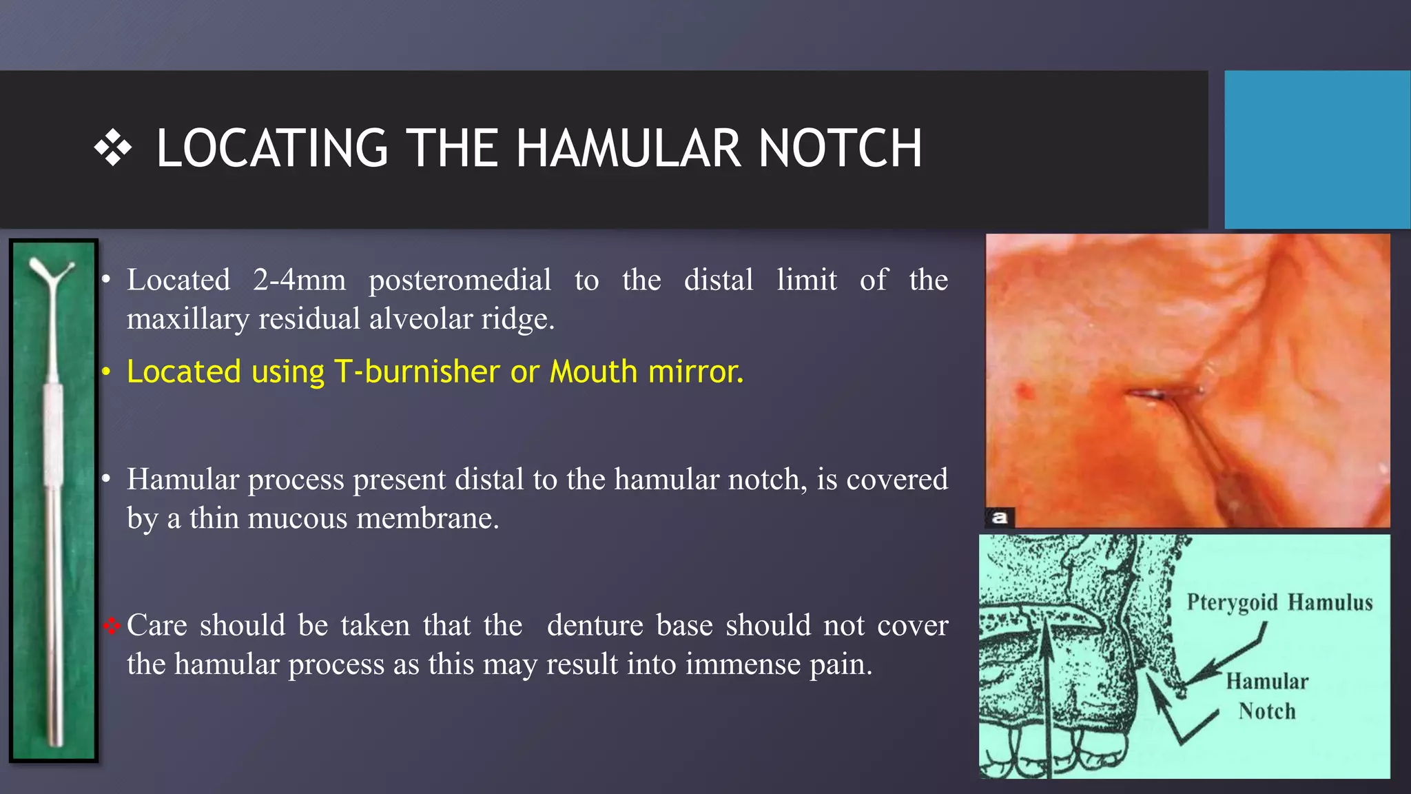Posterior Palatal Seal Area | PPTX